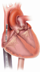 QuickDraw Plus Cannula – enableCV